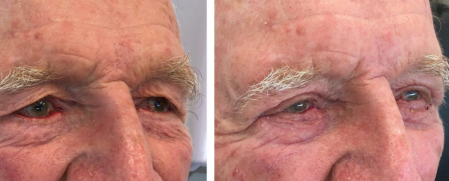 Plastic surgery before & after photos | Eyelid Ectropion